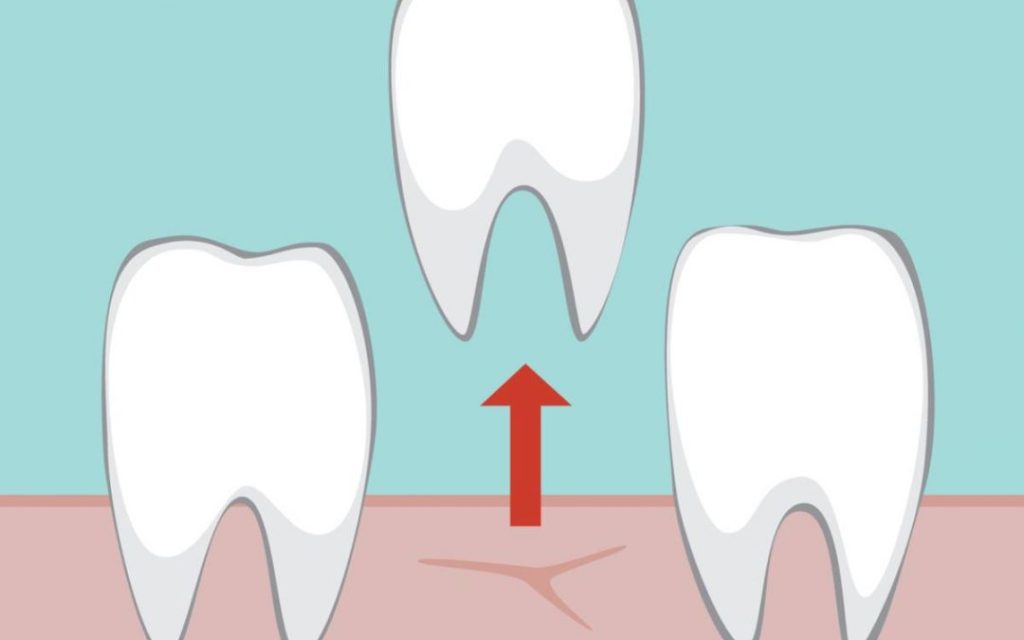 Does tooth extraction need stitches? | Maz Endo - Blog